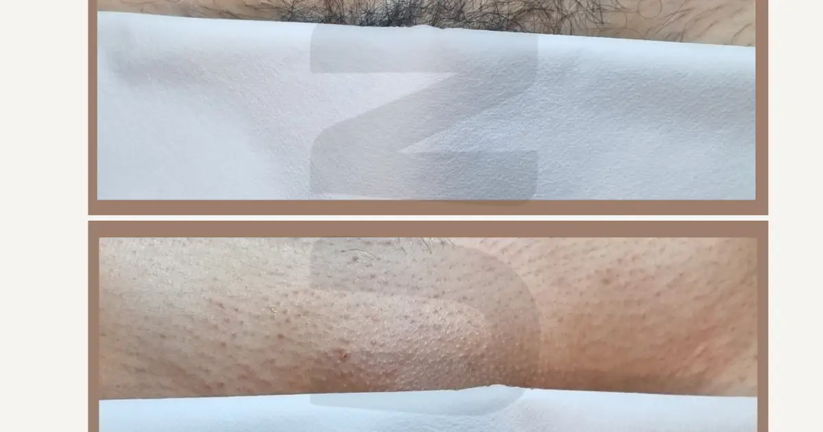브라질리언 시술 남자왁서 숨고 숨은고수