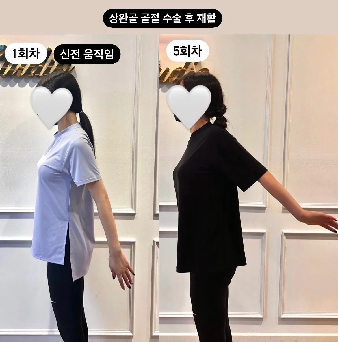 상완골 골절 재활 Before And After 정현희 숨고 숨은고수