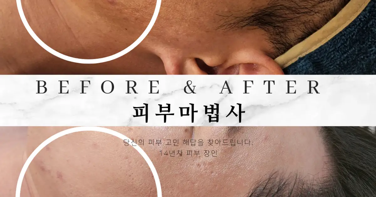 여드름흉터 재생모공문제성피부 피부마법사 숨고 숨은고수