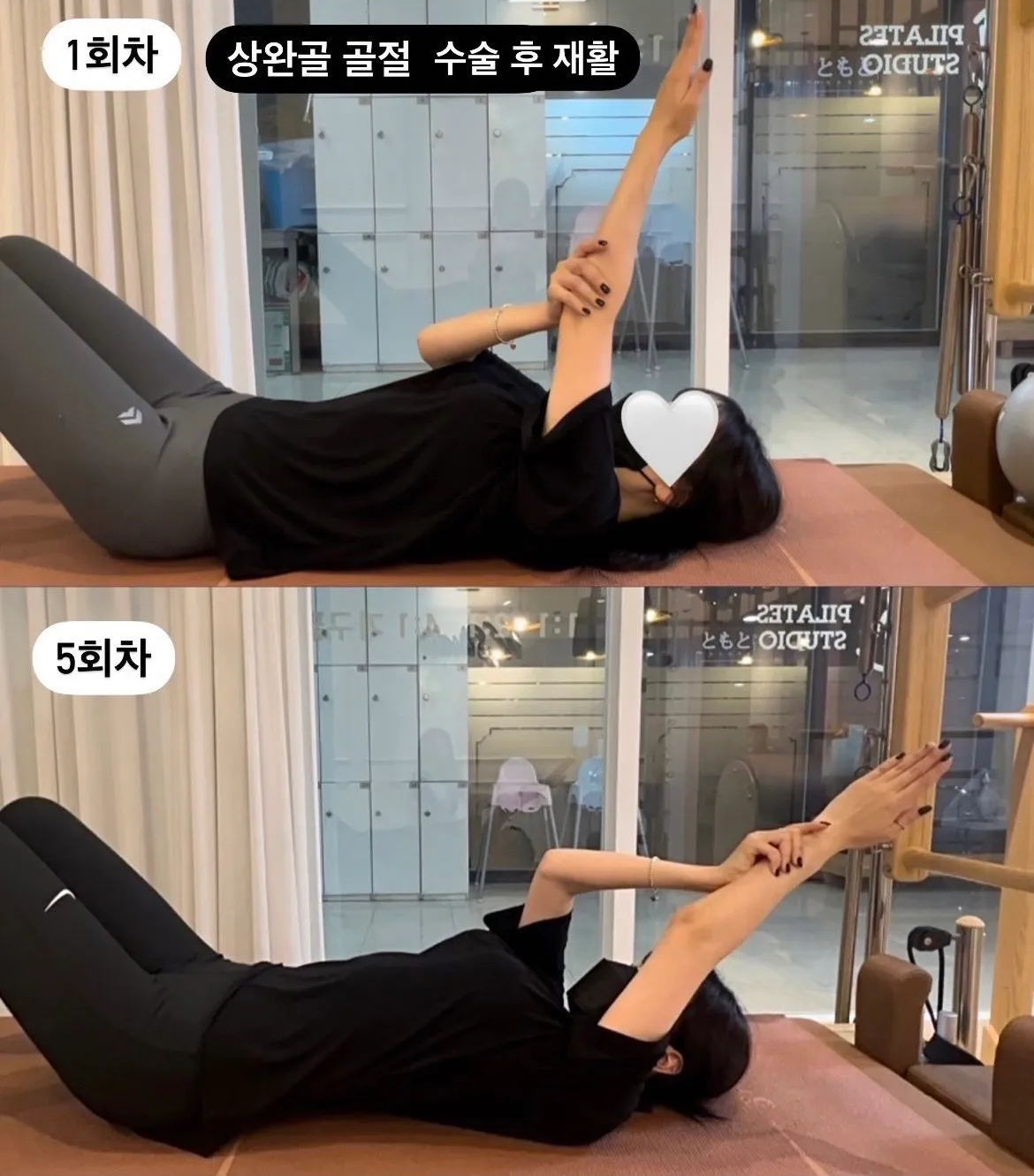 상완골 골절 재활 Before And After 정현희 숨고 숨은고수