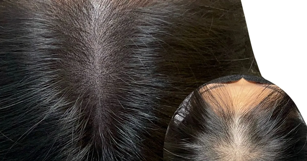 정수리 시술 디모드 Smp두피문신 서울제주전국 시술and아카데미 숨고 숨은고수