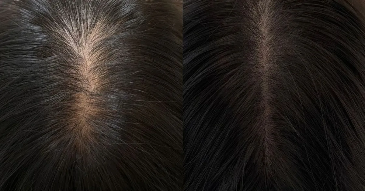 Smp두피문신 채인지유스칼프 숨고 숨은고수