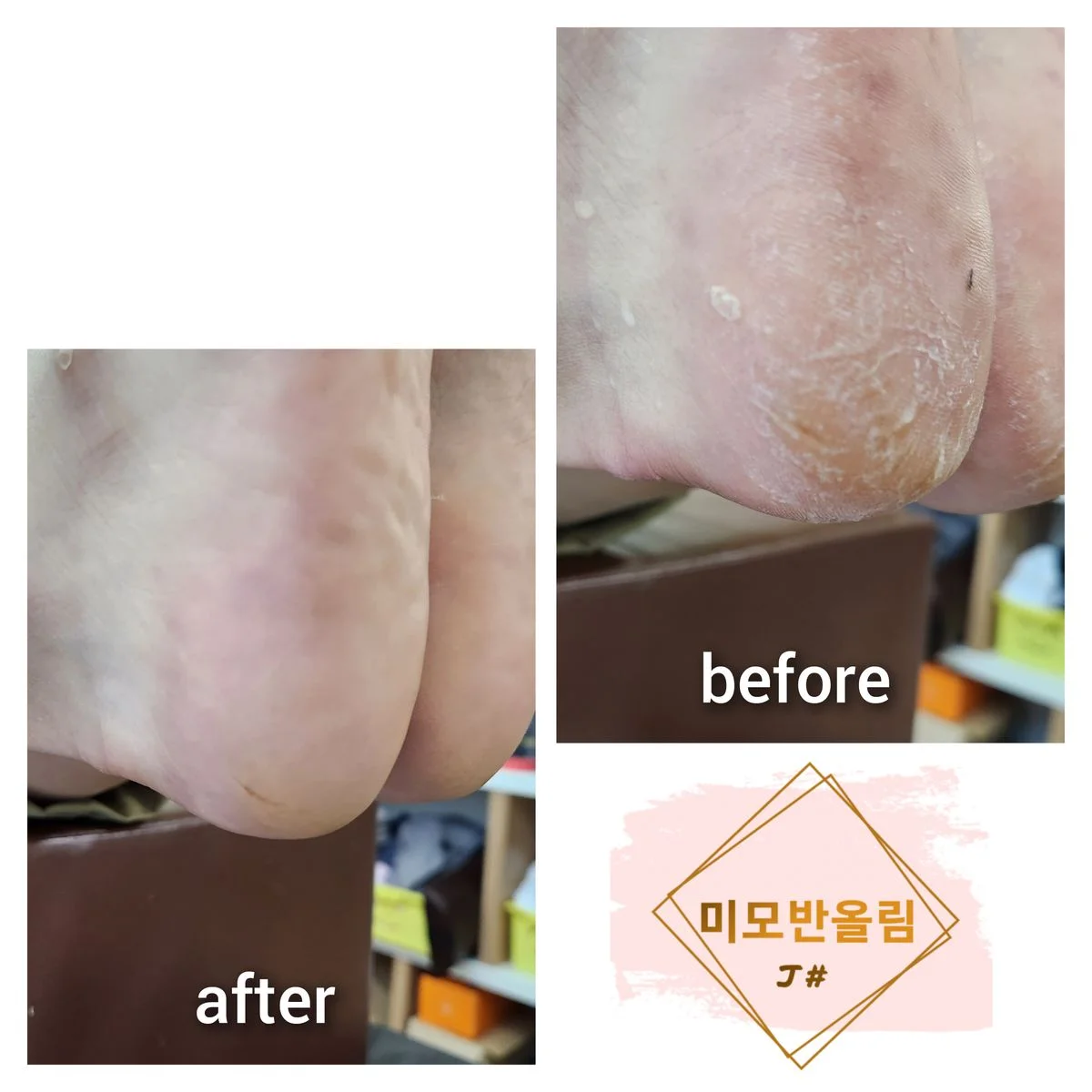 문제성 발 각질 관리 패디플래닝 김제희 숨고 숨은고수