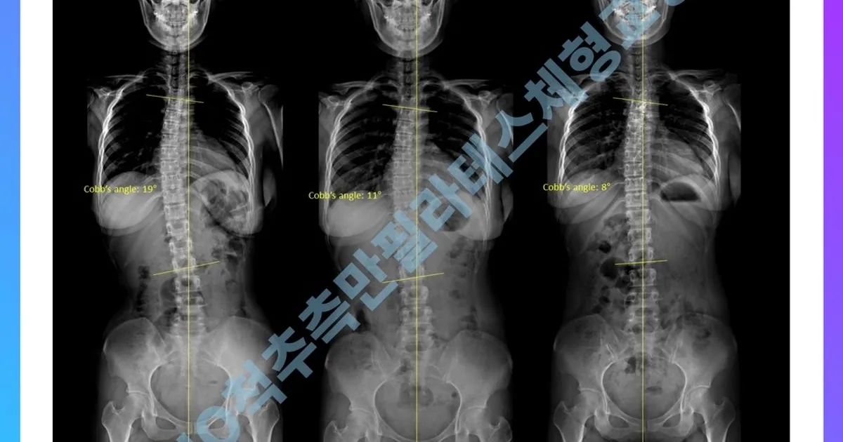 성인척추측만증 운동 전후비교 / 오세일 - 숨고, 숨은고수