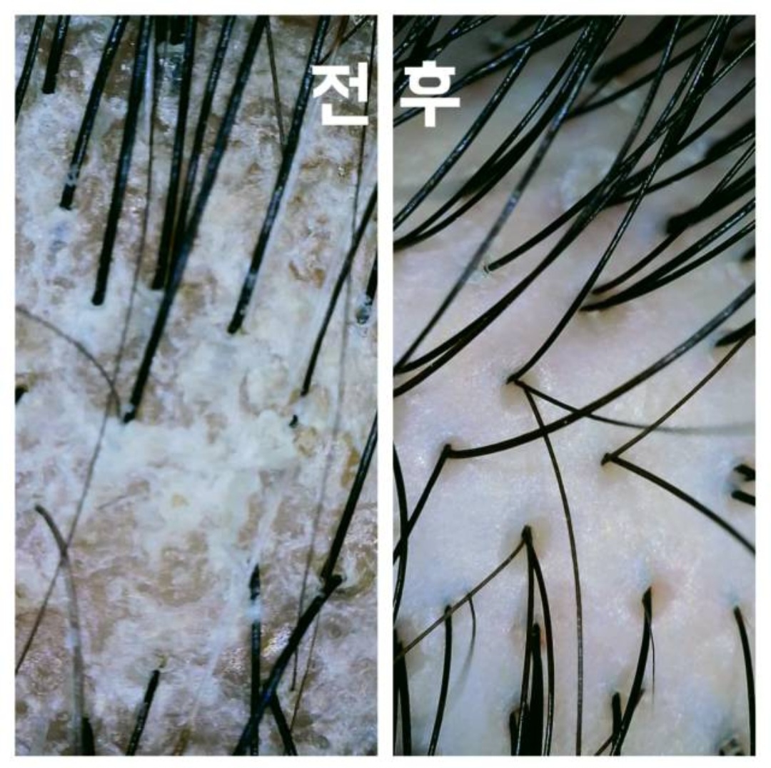 두피케어 김지혜 숨고 숨은고수