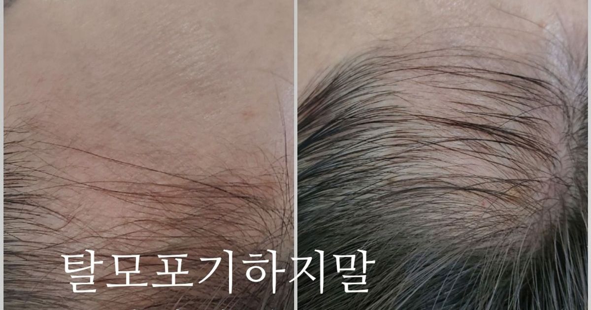 헤어라인 김은지 숨고 숨은고수