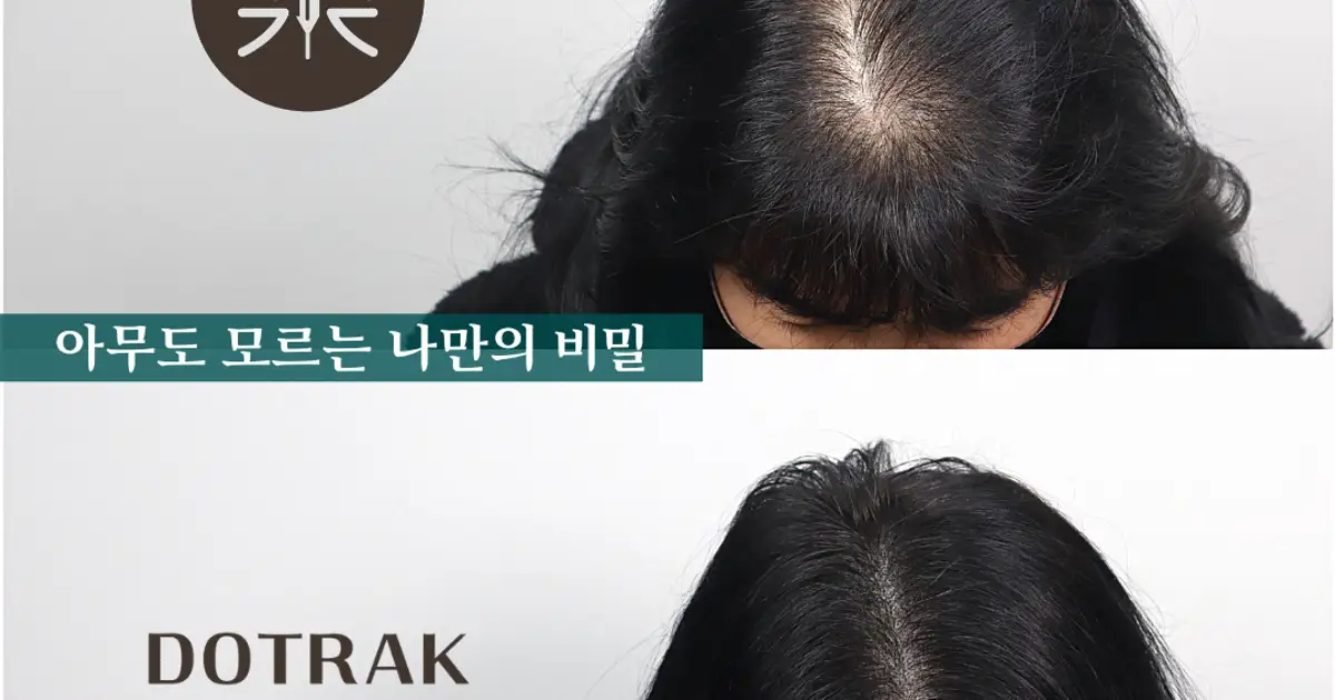 Smp 시술 포트폴리오 에이든 숨고 숨은고수