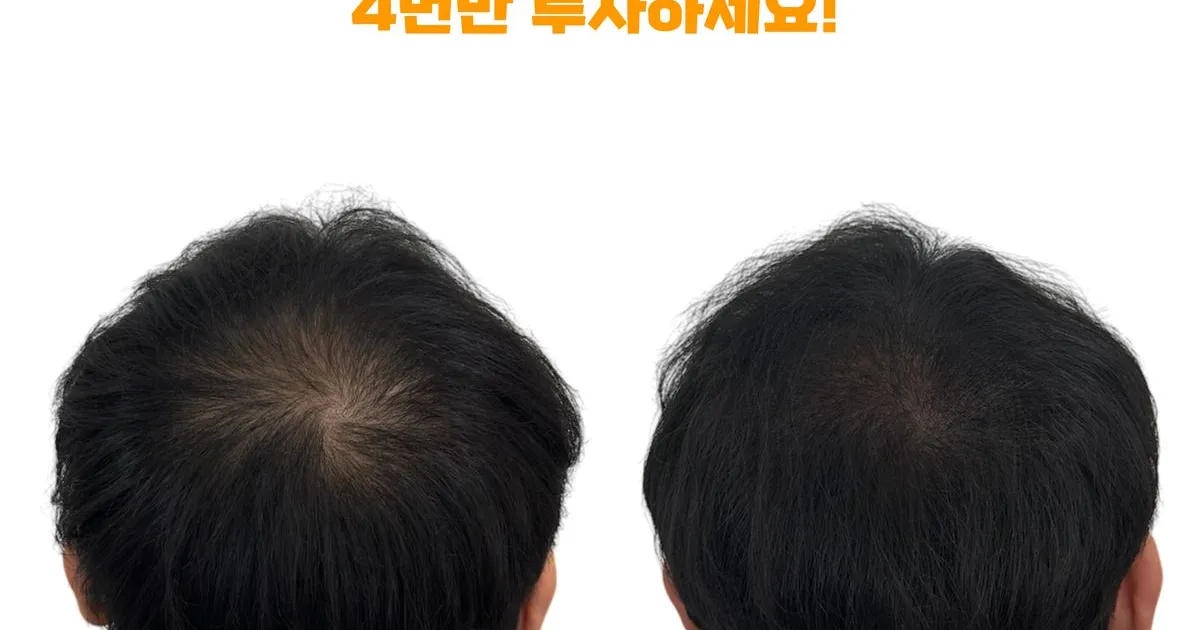 두피커버 작업 우며들다울산 안주희 숨고 숨은고수