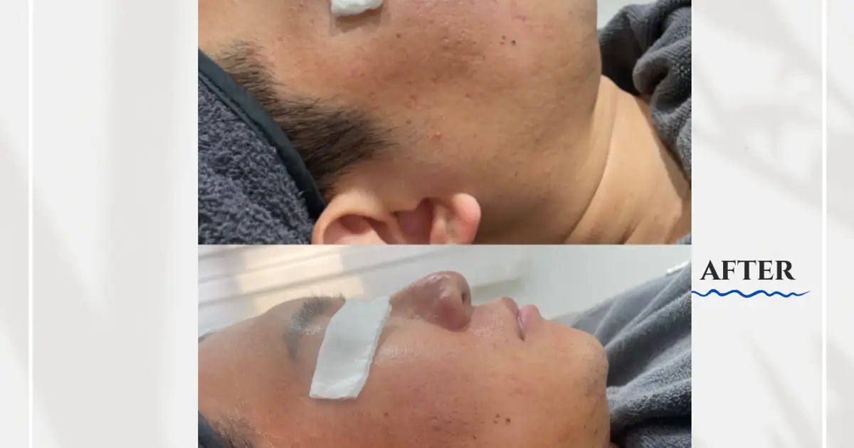 여드름자국흉터 관리 뷰네르뷰티 숨고 숨은고수