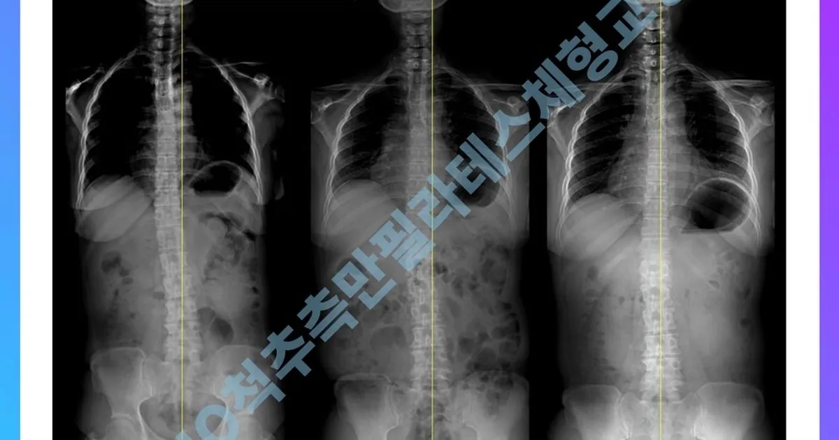 성인척추측만증 운동 전후비교 오세일 숨고 숨은고수