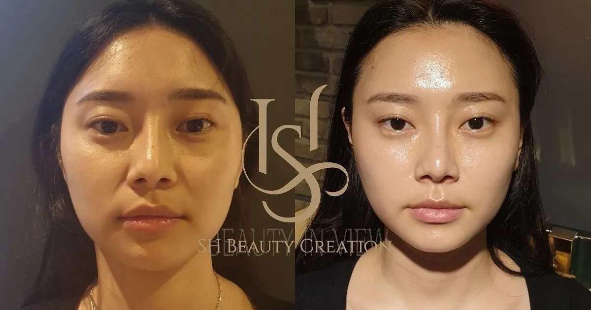 동안리프팅 정서형 숨고 숨은고수