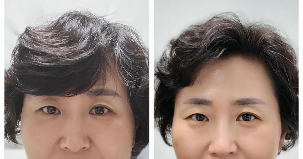피부 개선 사례 얼굴 형 보정 사례 박정유 숨고 숨은고수