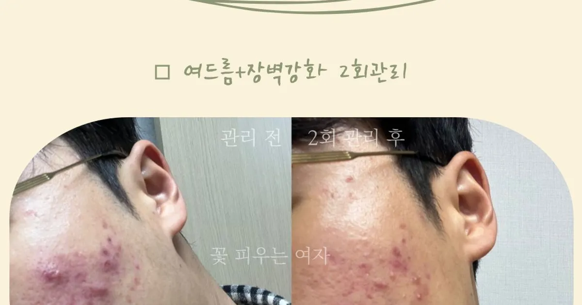 여드름장벽강화 2회 유나인 숨고 숨은고수