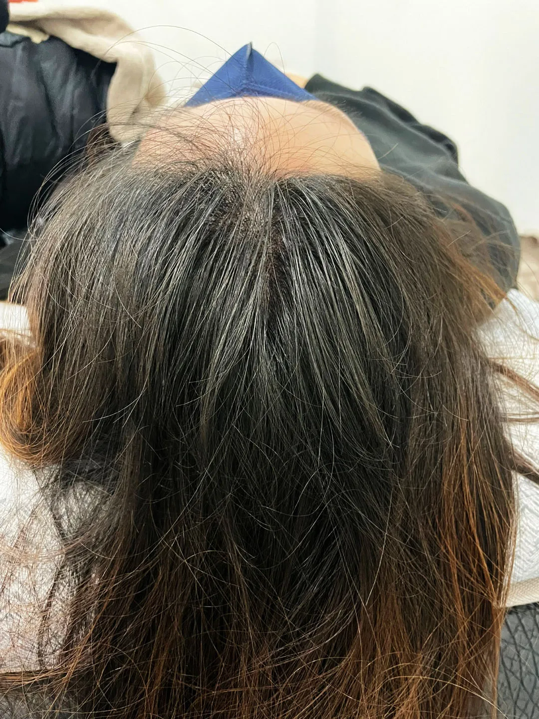 증모술 대신 두피문신 모모스칼프 숨고 숨은고수