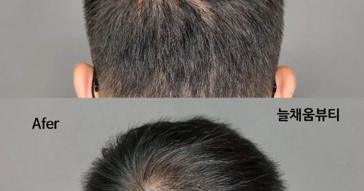정수리 두피문신 김병주 숨고 숨은고수