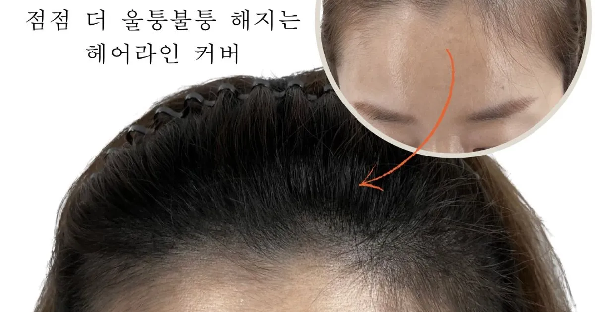 헤어라인 커버왕 숨고 숨은고수
