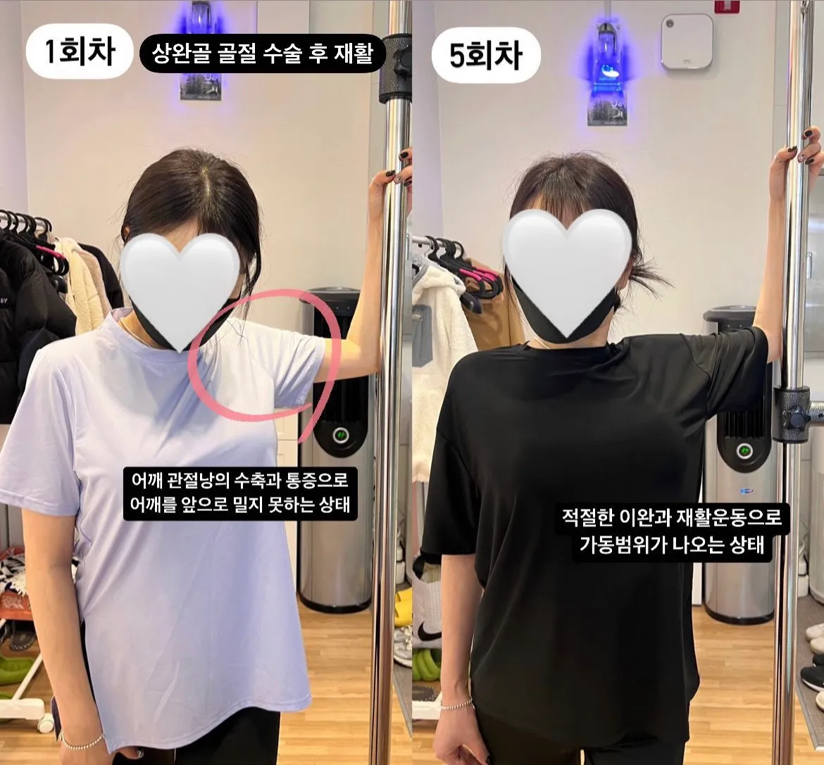 상완골 골절 재활 Before And After 정현희 숨고 숨은고수