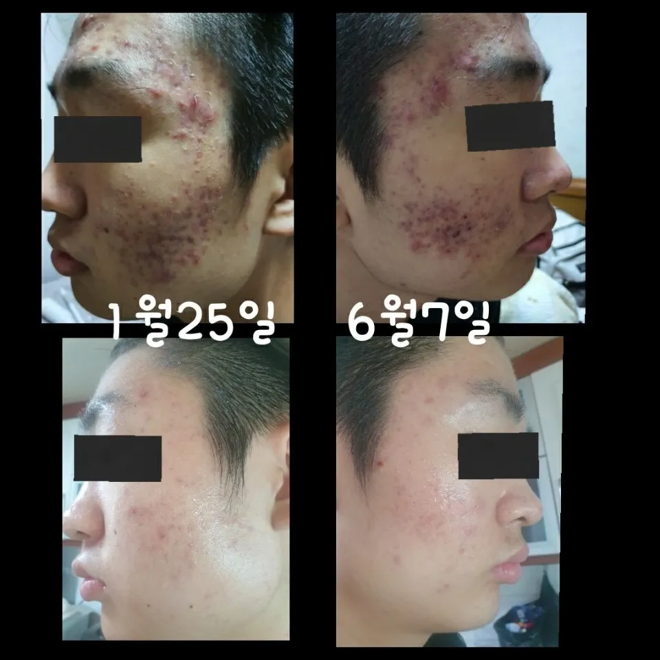 피부 개선 사례 얼굴 형 보정 사례 박정유 숨고 숨은고수