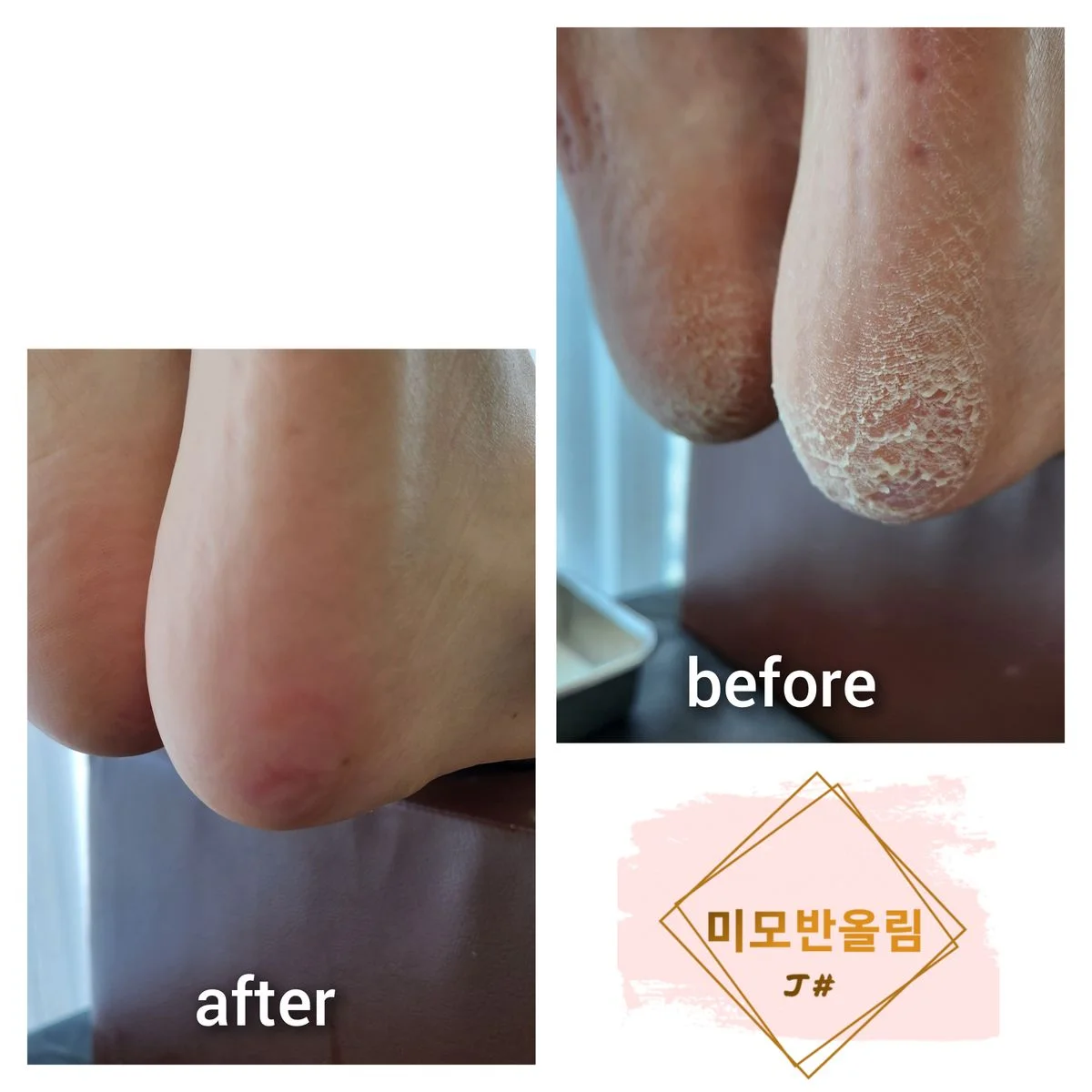 문제성 발 각질 관리 패디플래닝 김제희 숨고 숨은고수