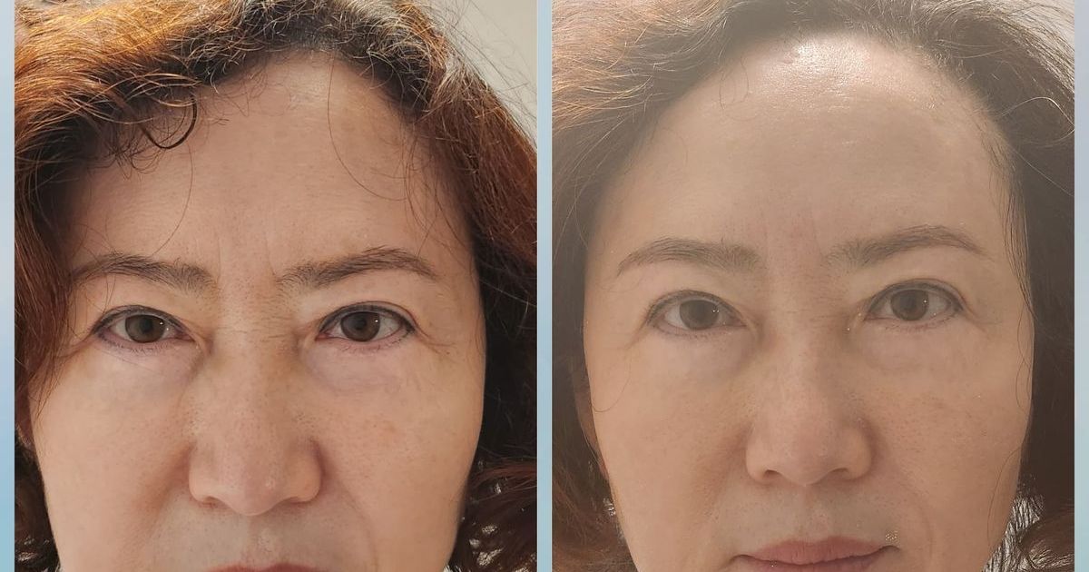 리프팅 얼굴경락관리 전후사진 이은숙 숨고 숨은고수