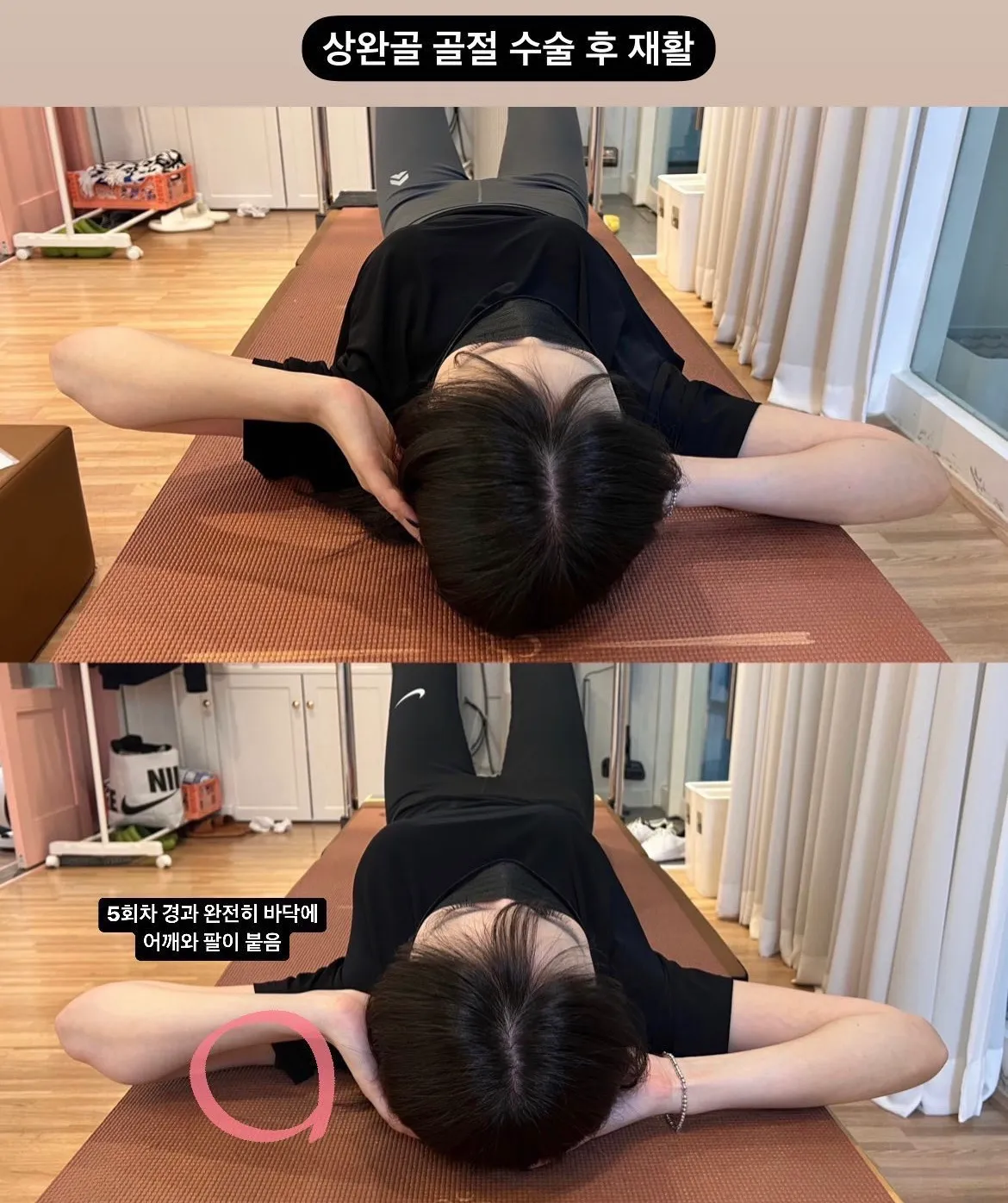 상완골 골절 재활 Before And After 정현희 숨고 숨은고수