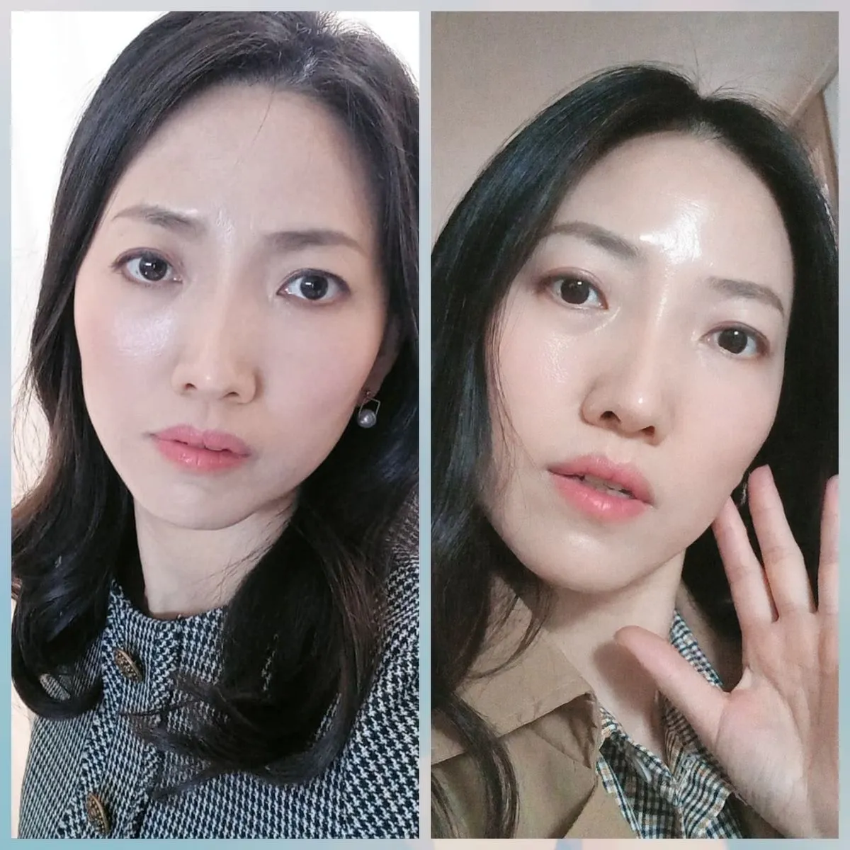 피부 성형관리 인셀덤rs골든로즈대리점 숨고 숨은고수