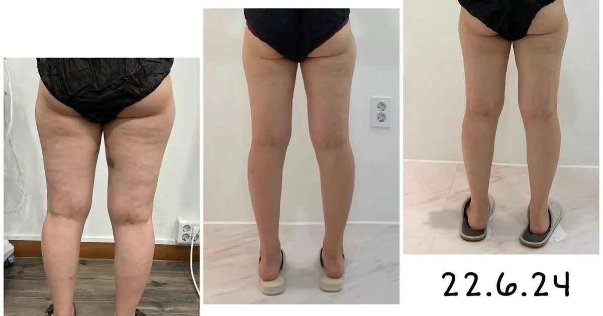 테라노바 다이어트 붓기 부종 동은지 숨고 숨은고수