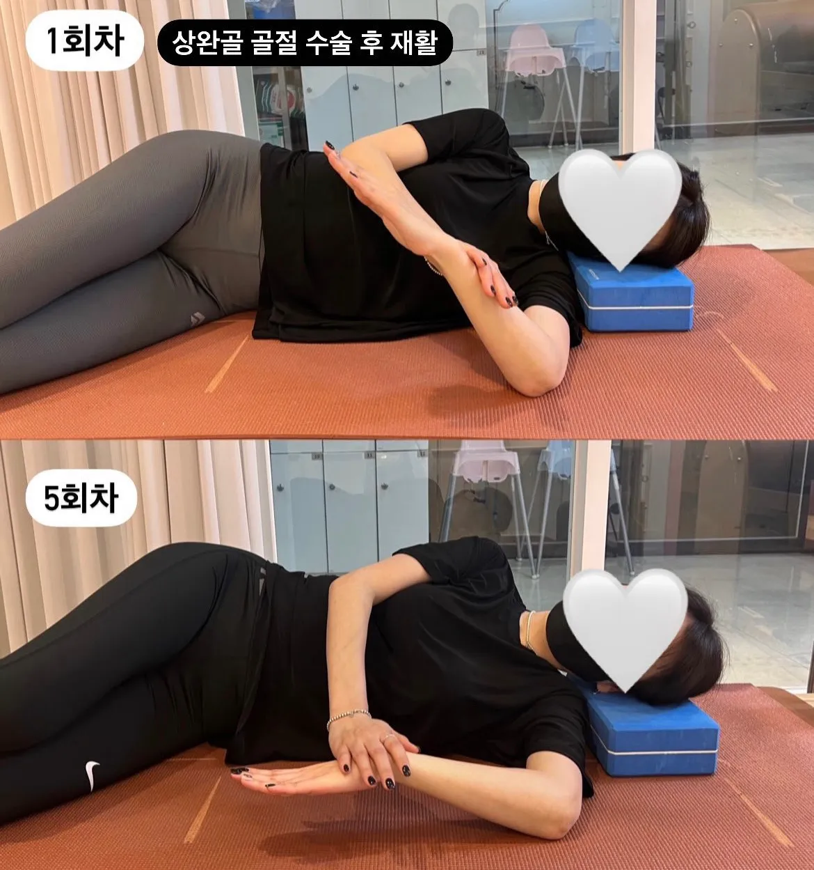 상완골 골절 재활 Before And After 정현희 숨고 숨은고수